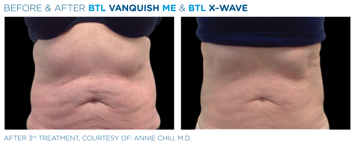 BTL_Vanquish-ME_BTL-X-wave_PIC_Ba-card-female-abdomen-018_EN100 ...